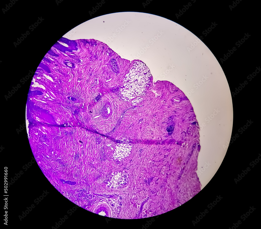 Skin Cancer: Skin biopsy under microscope showing Basal cell carcinoma ...