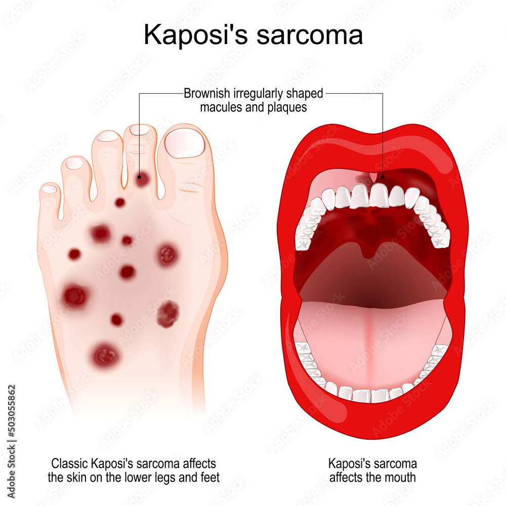 Kaposi's sarcoma. cancer. skin lesions Stock Vector | Adobe Stock Kaposi's sarcoma. cancer. skin lesions Stock Vector | Adobe Stock