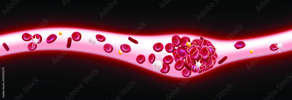 3D illustration of a blood clot in a blood vessel showing a blocked ...