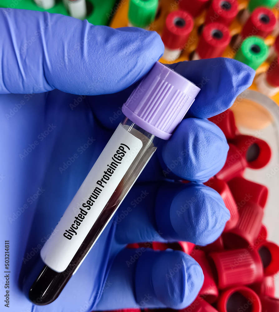 Blood sample for Glycated Serum Protein(GSP) test or Fructosamine test ...