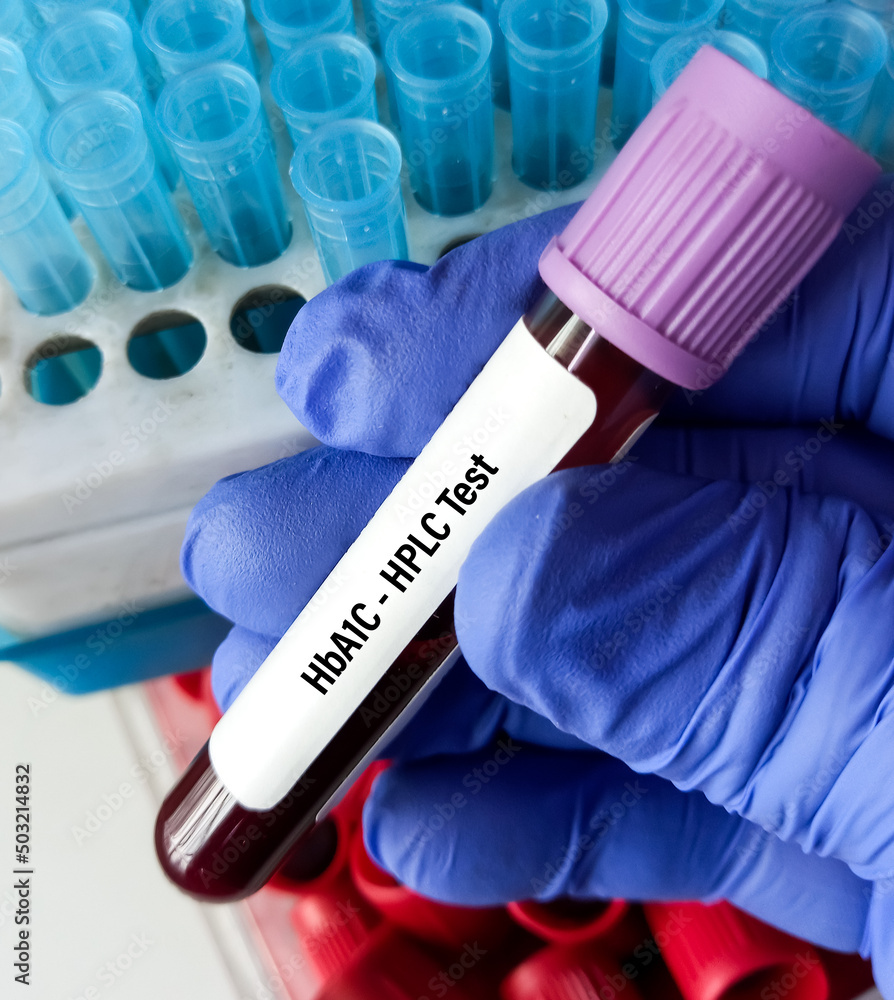 Blood sample for HbA1c - HPLC test, diabetes diagnosis. Stock Photo ...