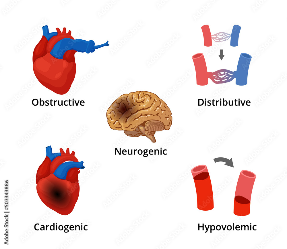 5 types of shock infographics. The diagram with the illustrations of ...