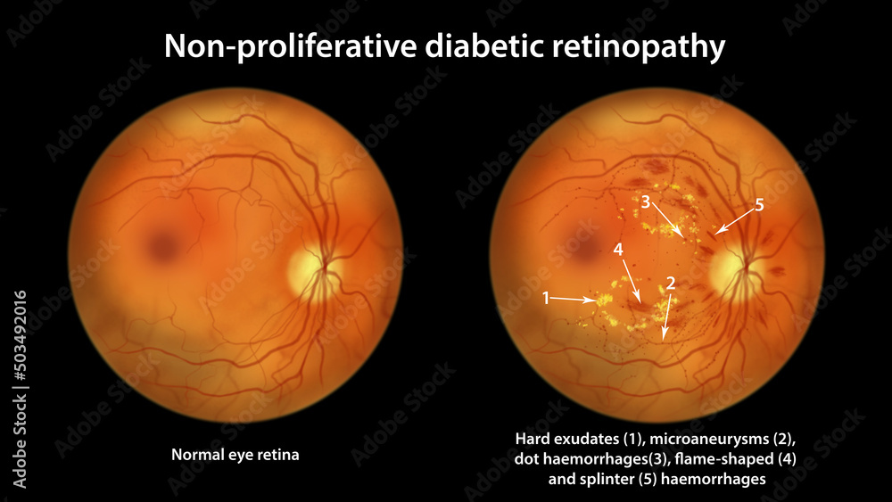 Non-proliferative diabetic retinopathy, illustration Stock Illustration ...