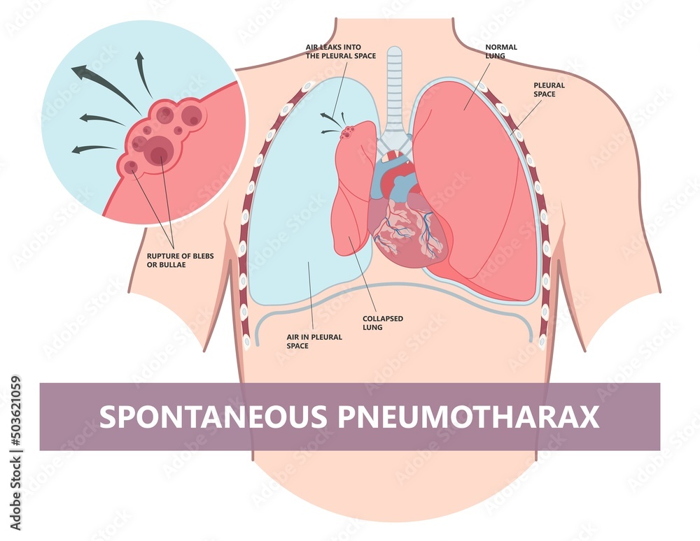 Lung cancer collapse chest pain drain rib bleb blunt insert tube fluid ...