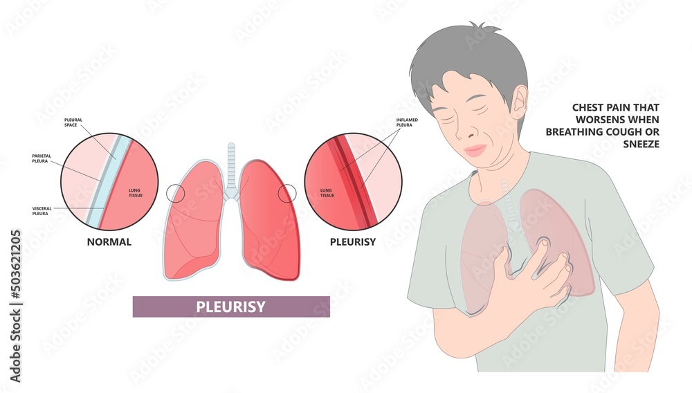 Pleurisy Lung covid 19 virus lupus pain chest xray fluid pleura ...