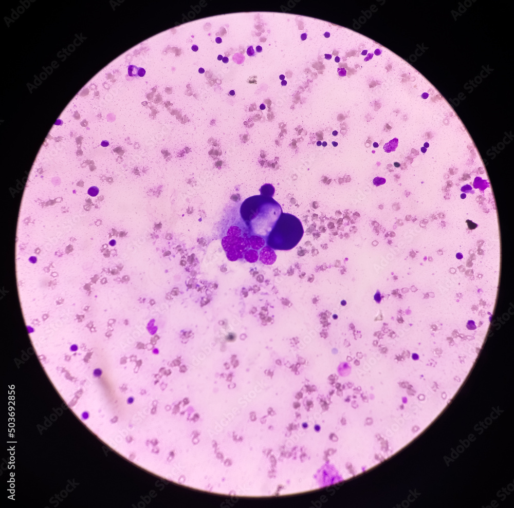 Microscopic view of blood smear, hematological stained slide, abnormal ...