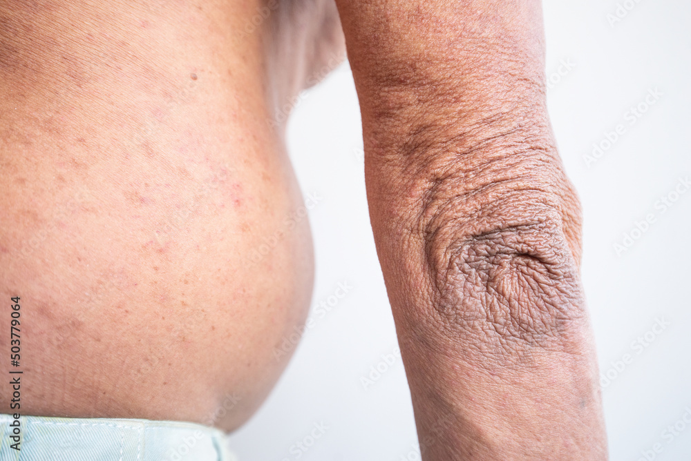 Wrinkled, darkened skin around the muscles and joints of the human body ...