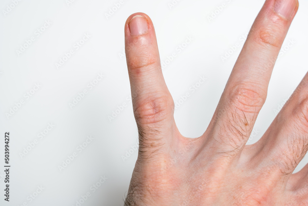 A protruding bone on the finger of the hand. Incorrect bone fusion ...