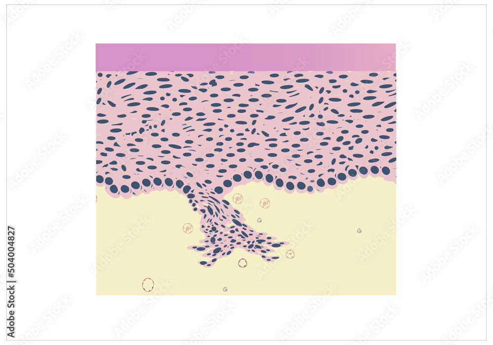 morphology of cervical cancer under a microscope, illustration, vector ...