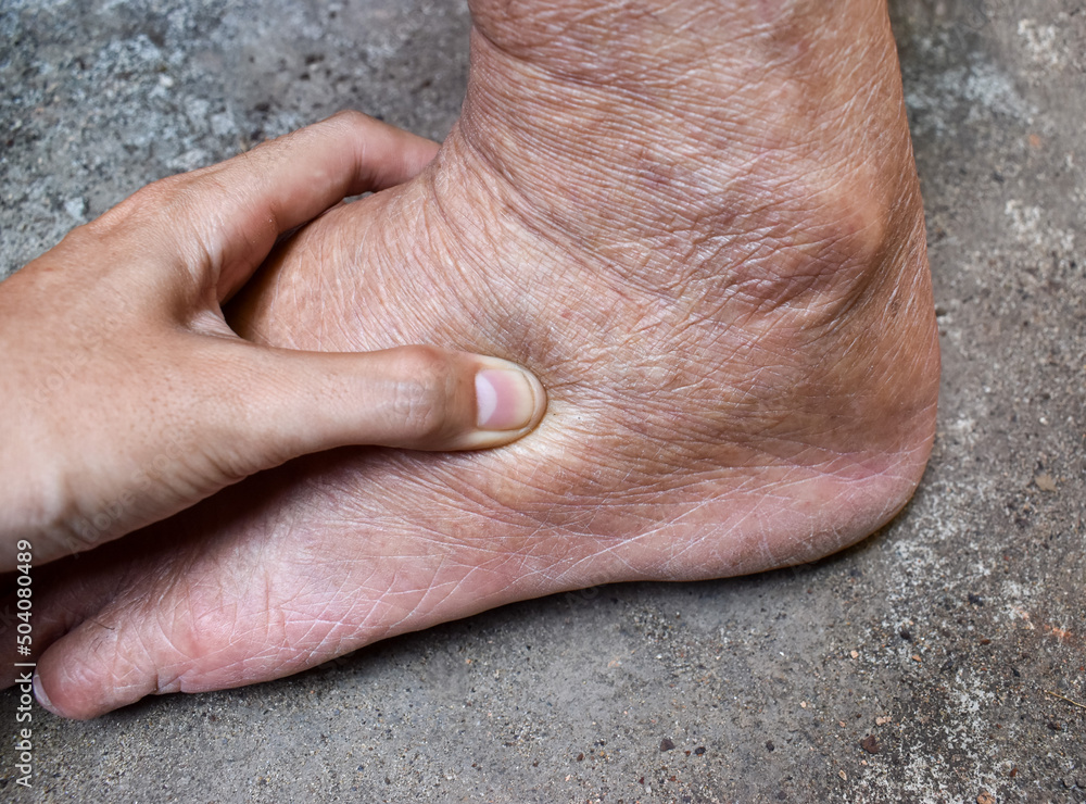 Pitting edema of lower limb. Swollen leg of Asian man. Photos | Adobe Stock
