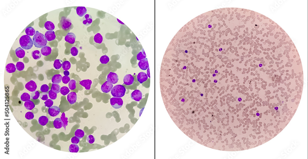 Photo college of Acute myeloid leukemia (AML) is a type of blood cancer ...