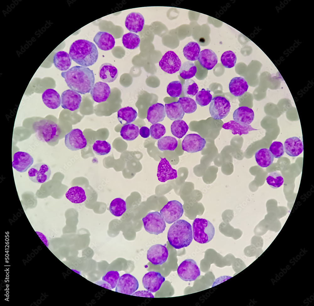 Acute myeloid leukemia (AML) is a type of blood cancer. Microscopic ...
