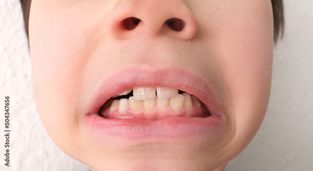 child, kid shows tooth that sways and hurts, the concept of pediatric ...