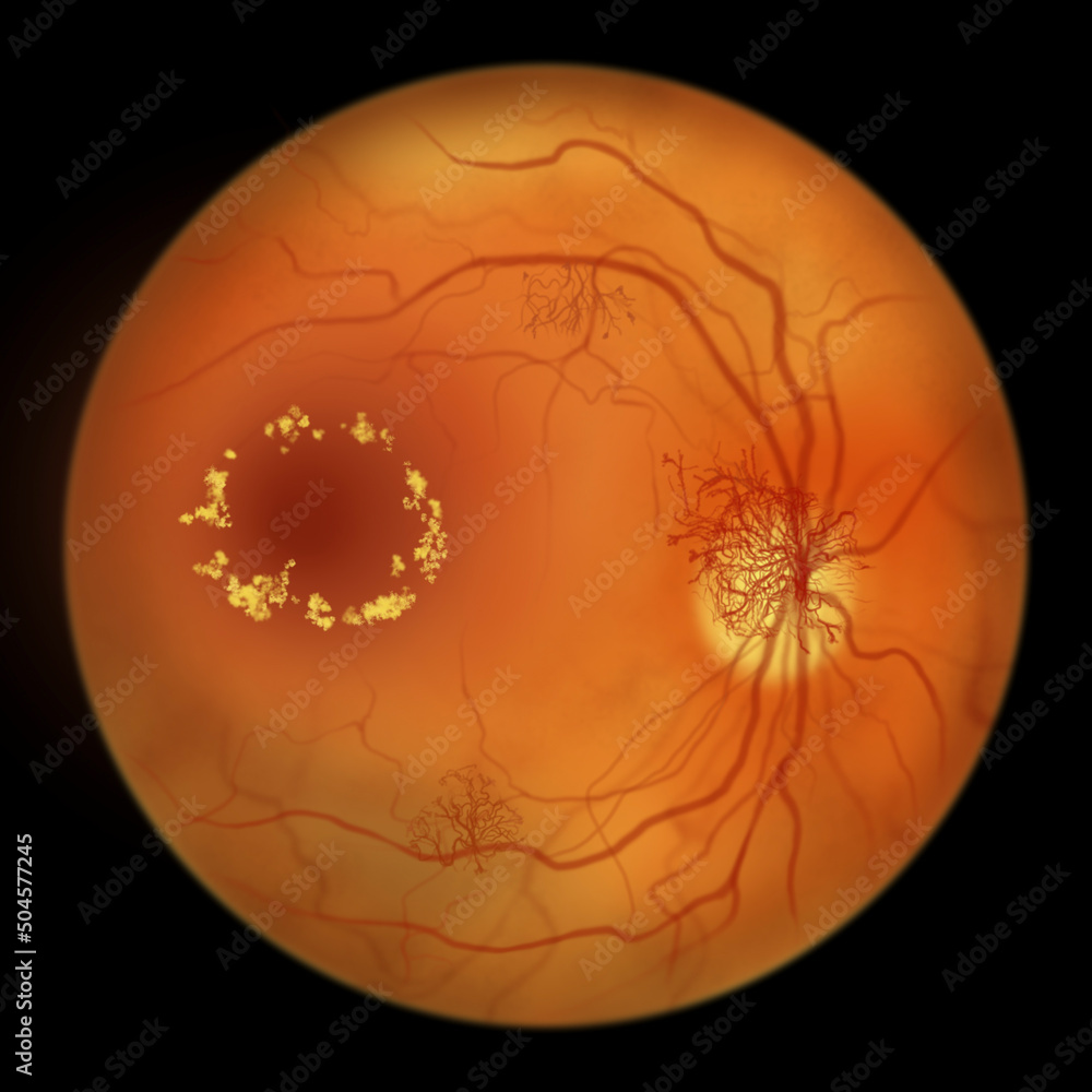Diabetic retinopathy, ophthalmoscopic diagnosis, illustration Stock ...