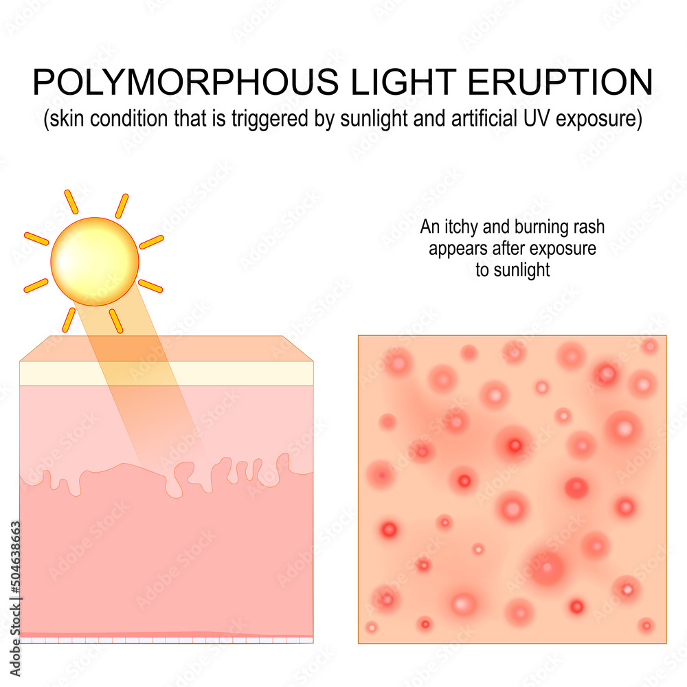 Polymorphic Light Eruption Face