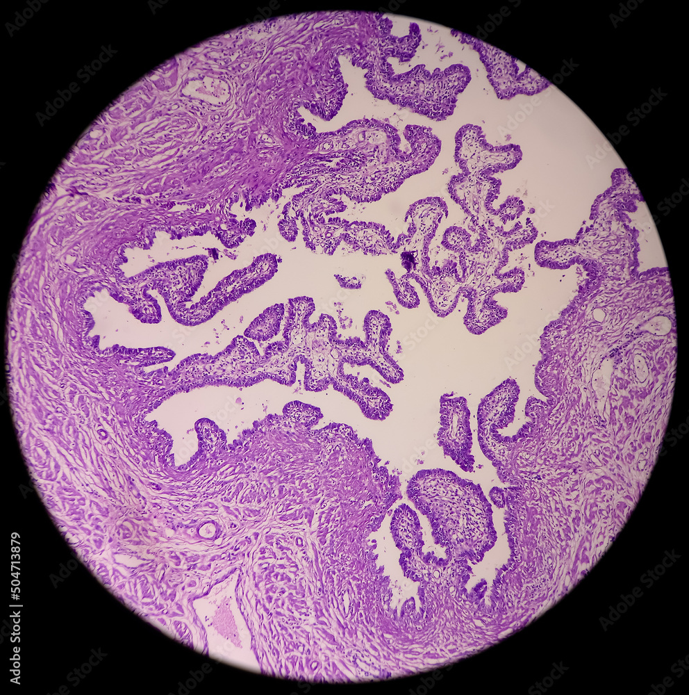 Fallopian tube(biopsy): features of hydrosalpinx(Blocked Fallopian Tube ...