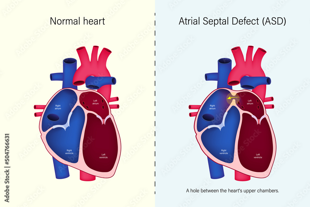 The difference of normal heart and atrial septal defect (ASD) vector ...