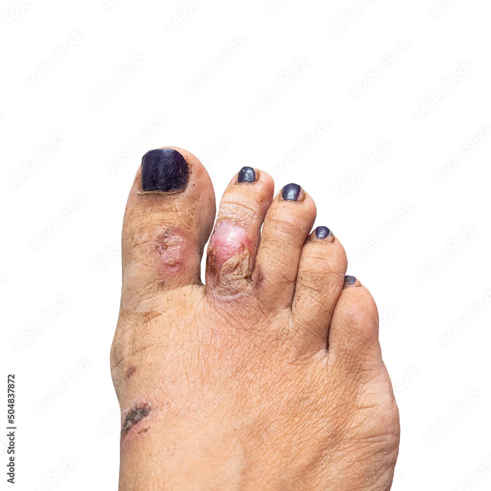 Woman foot with hot water burn wound isolated on white background ...