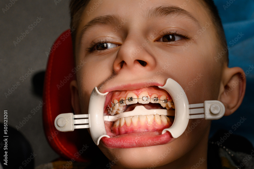 Visit to the orthodontist, installation of braces on the upper teeth ...