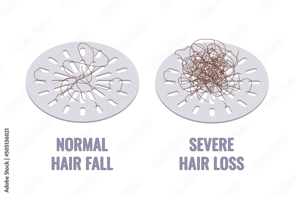 Hair clumps stuck in the shower drain grids. Normal hair fall versus ...