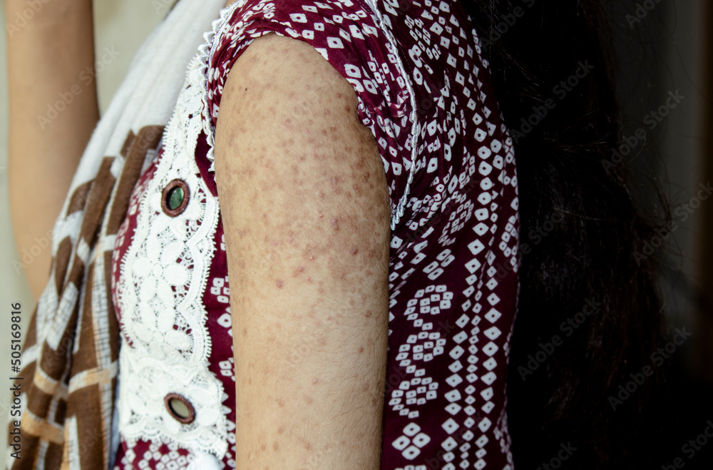 Close Up Dermatitis On The Skin Fungus Allergy Fungus Of Skin The Concept Dermatology
