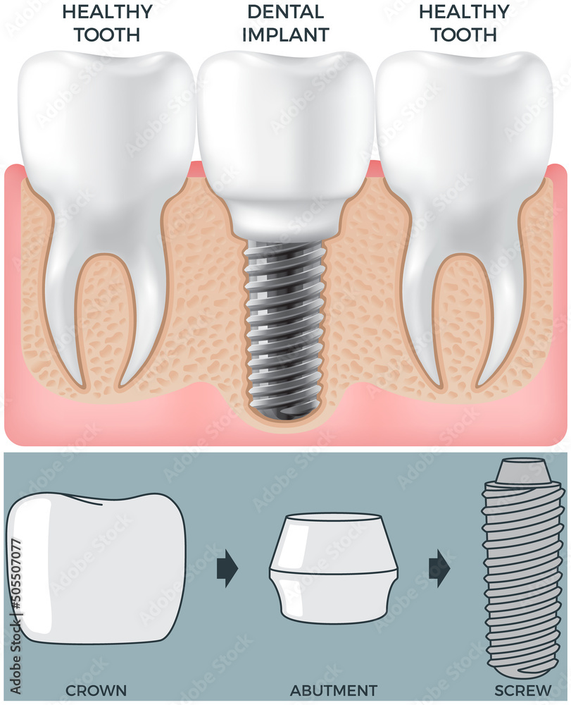 Human jaw with normal teeth and prosthesis above dental implant ...