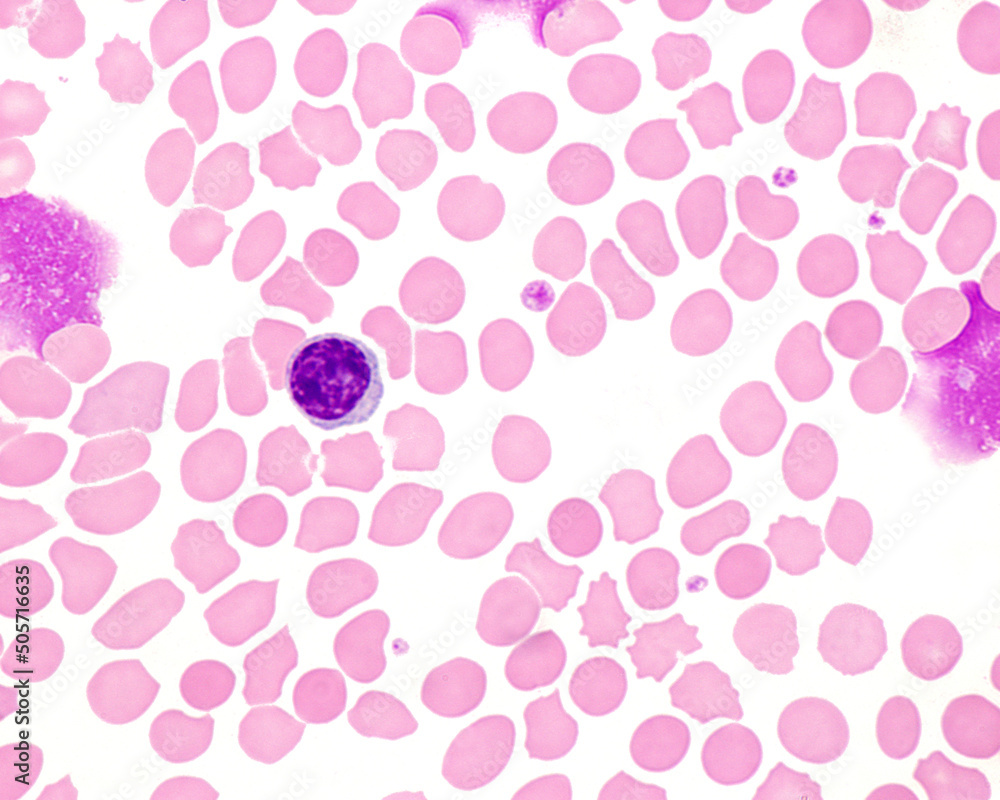 Human blood smear. Lymphocyte Stock Photo | Adobe Stock