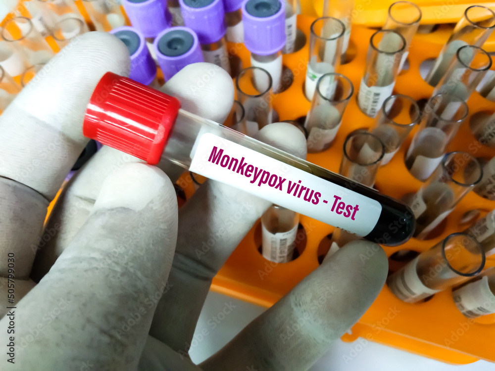 Blood sample tube for Monkeypox virus test. It is also known as the ...