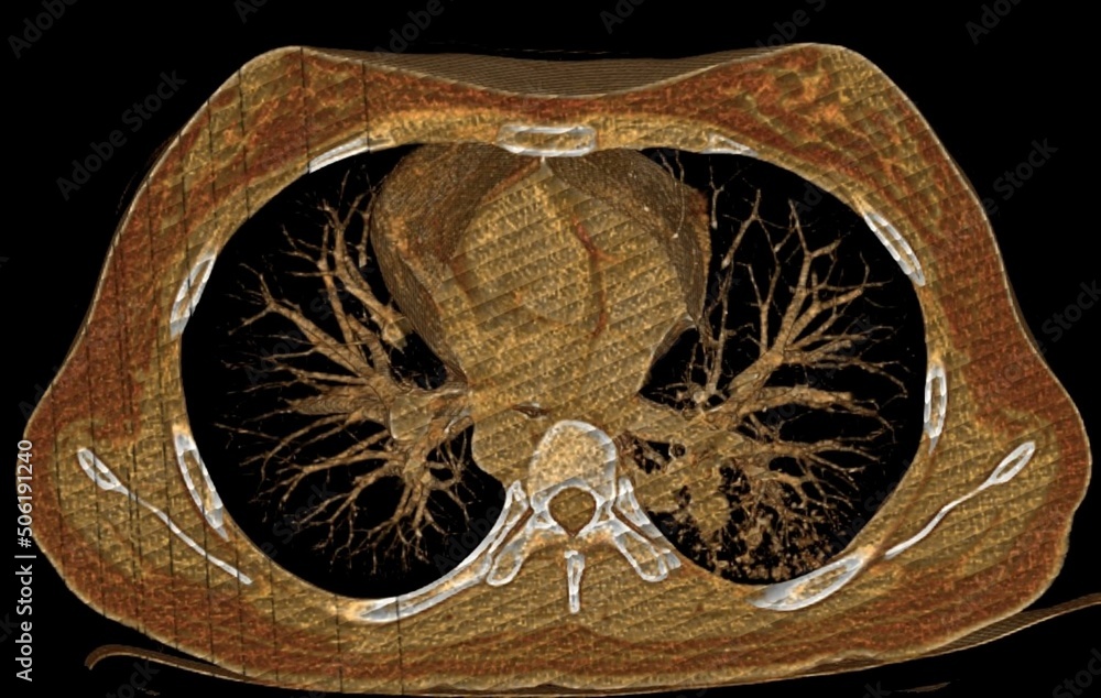 Colored 3d chest ct scan showing heart,lung, vascular, liver, and bowel ...