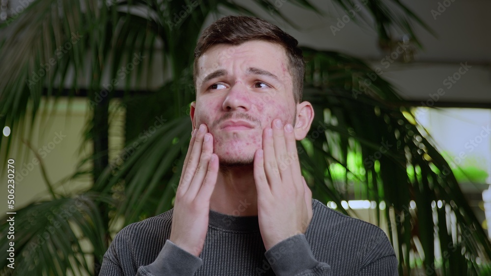 Close-up of a young man with pimples on his face. The guy is sad and ...