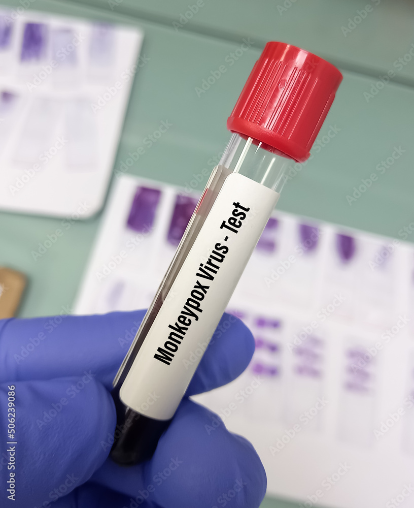 Blood sample tube for Monkeypox virus test. It is also known as the ...