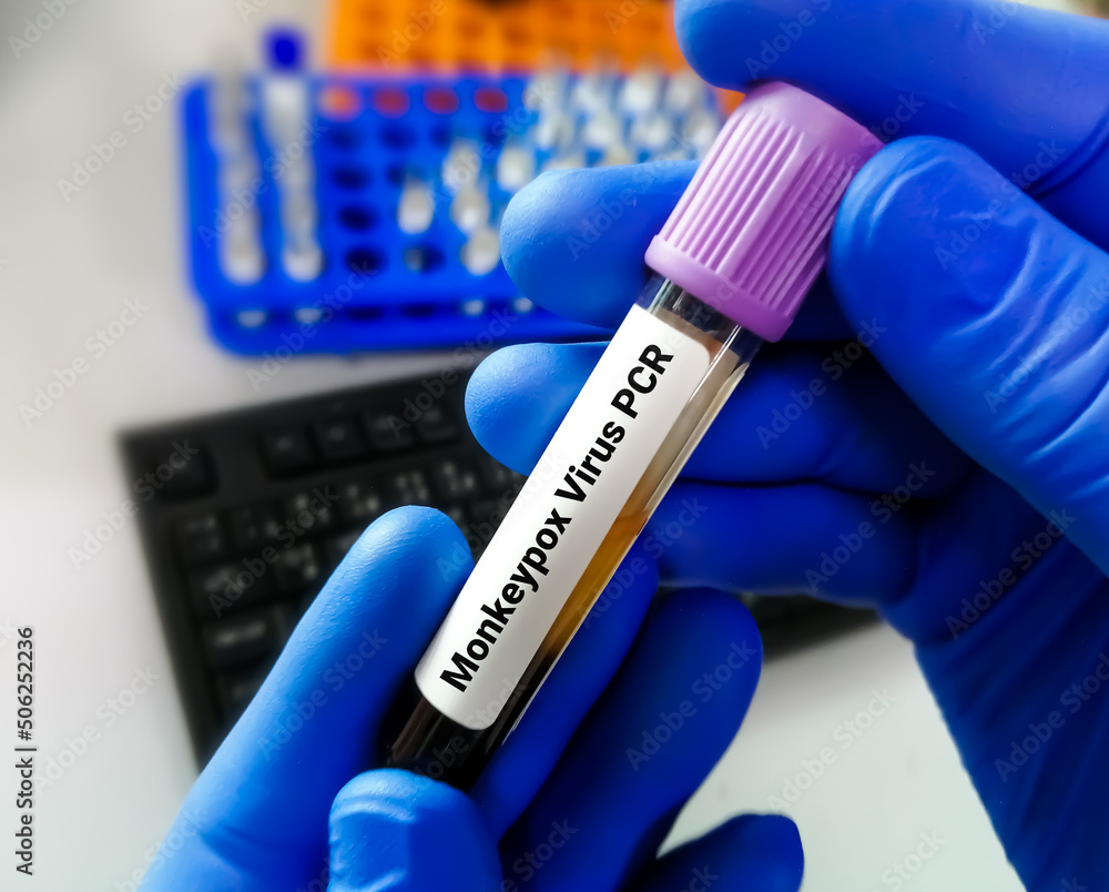 Fotografia do Stock: Blood sample for Monkeypox virus PCR test. It is ...