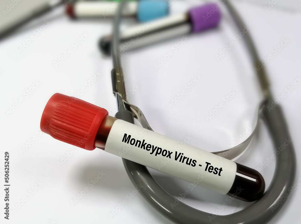 Blood sample for Monkeypox virus test. It is also known as the Moneypox ...
