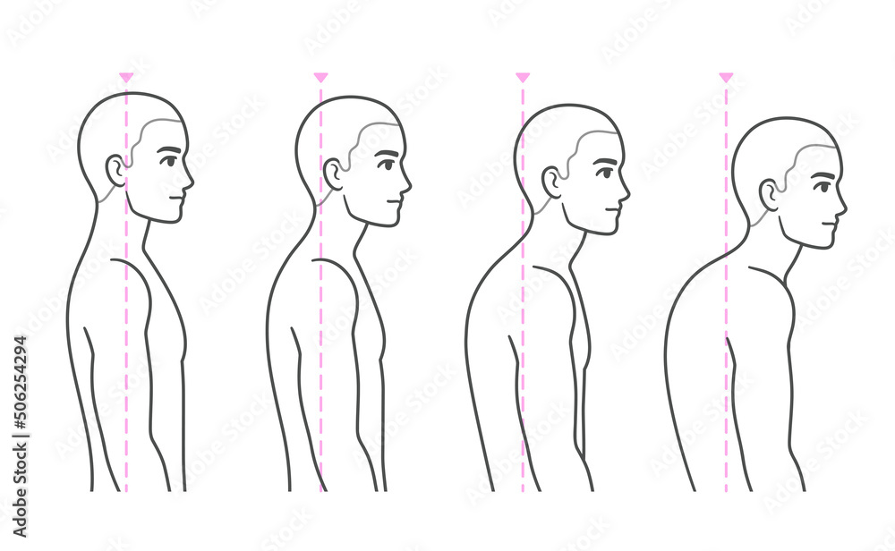 Spine kyphosis progression stages Stock Vector | Adobe Stock