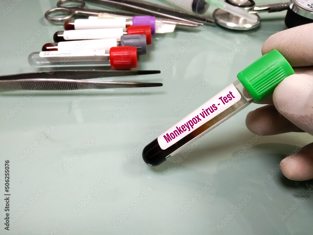 Blood sample tube for Monkeypox virus test. It is also known as the ...
