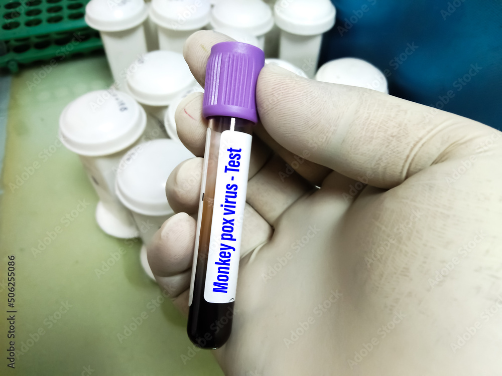 Blood sample tube for Monkeypox virus test. It is also known as the ...