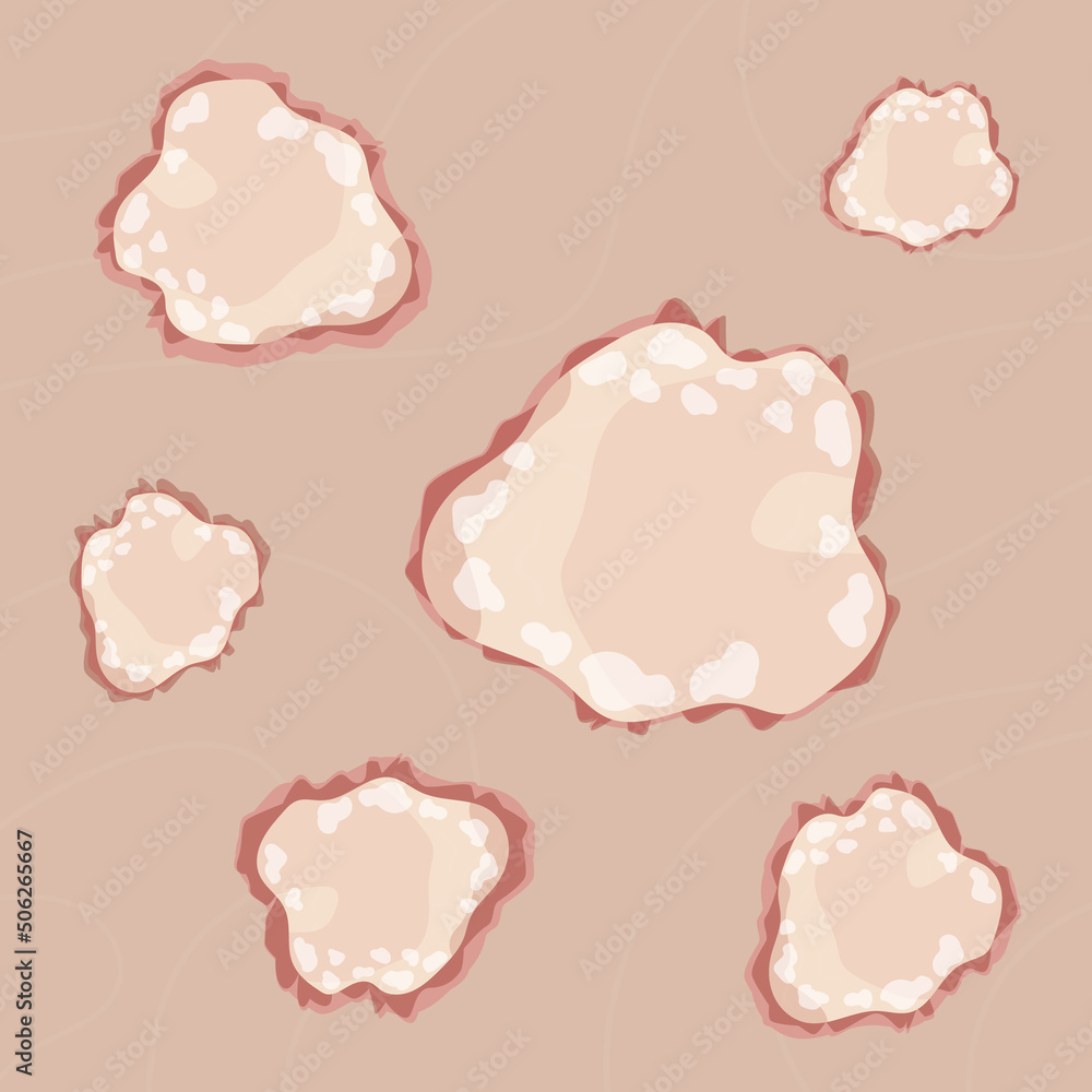 monkeypox on human skin. Close-up. Outbreak of a viral infection. Rash ...