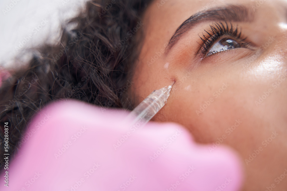 Photo Syringe needle penetrates under the skin under the eye along pre ...