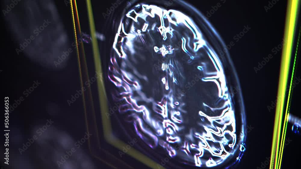 Magnetic resonance images of the brain (MRI brain) sagittal post ...