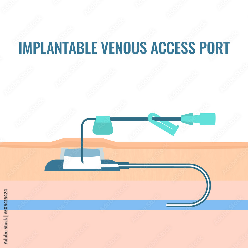 Implantable venous access port cross section illustration Stock Vector ...
