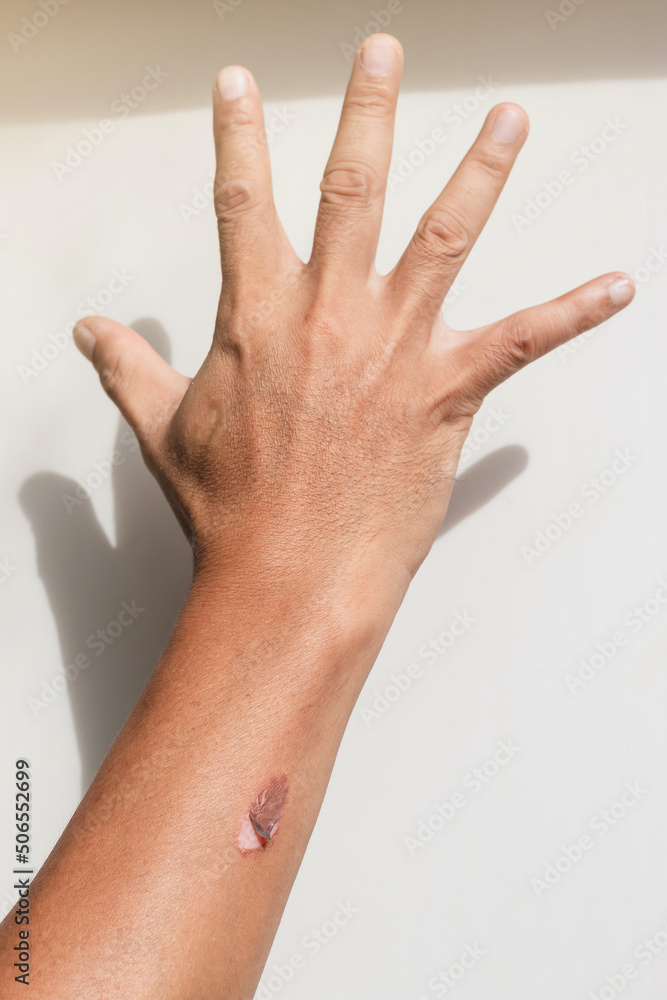 Skin burn: Burns and scalds - Superficial Second Degree Burn, Skin ...