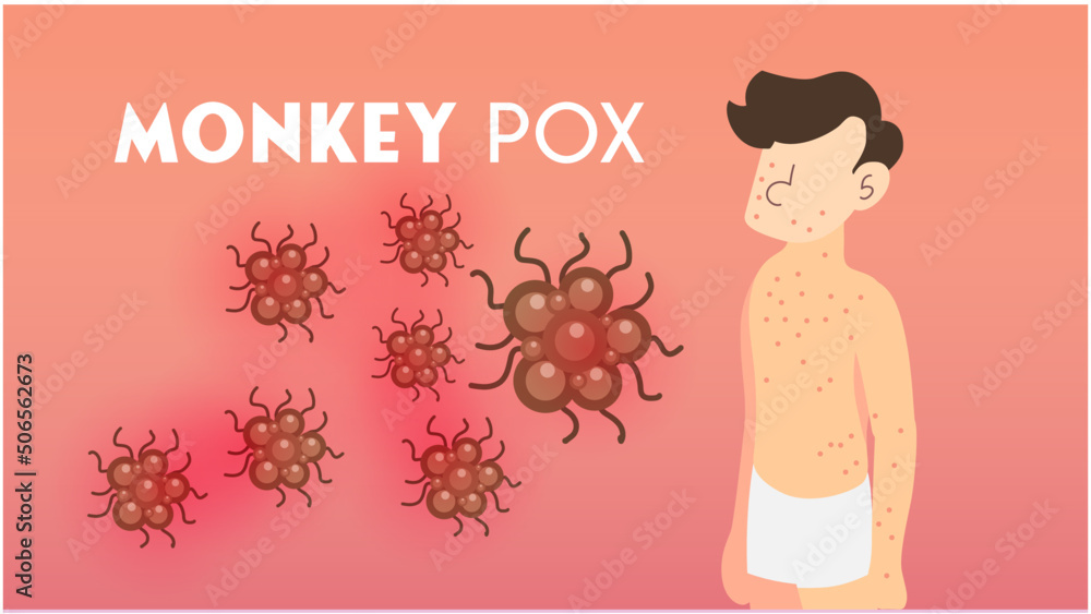 Illustration of monkeypox virus, Vector of a person with monkeypox ...