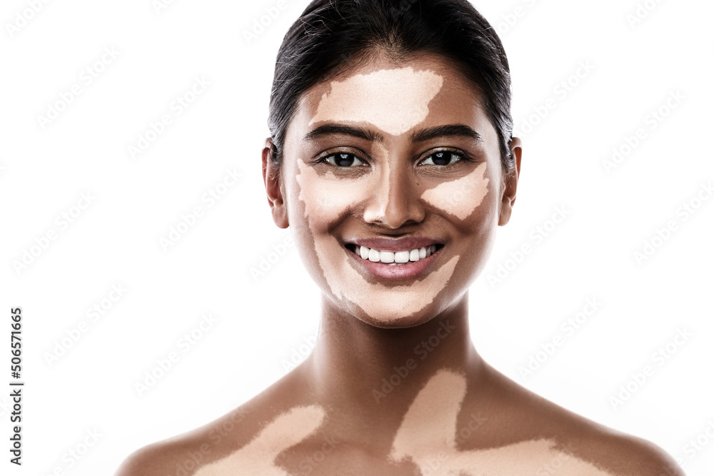 Beautiful South Asian woman with vitiligo skin disorder against white ...