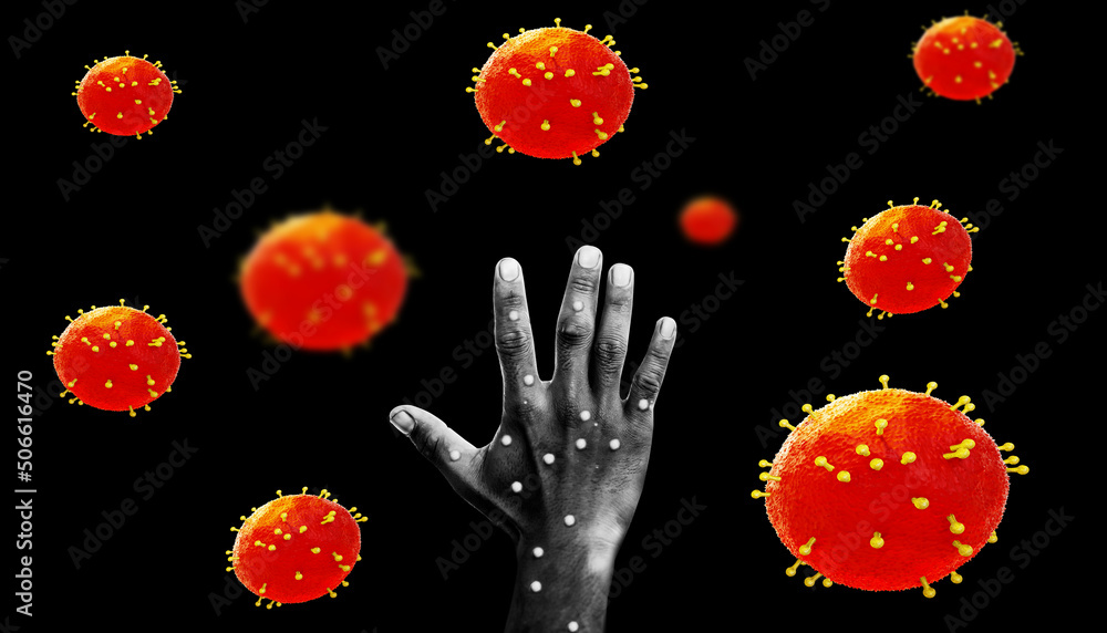 Monkeypox infection pandemic.African hand symptom monkeypox show doctor ...