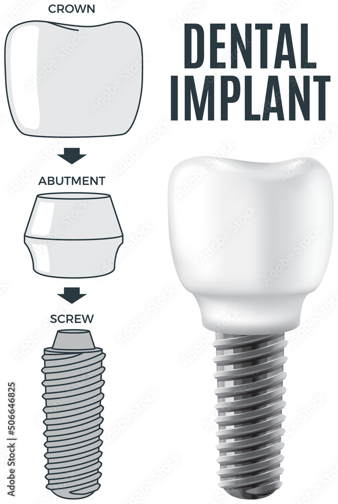 Realistic white dental implant and human tooth. Dentistry, medicine and ...