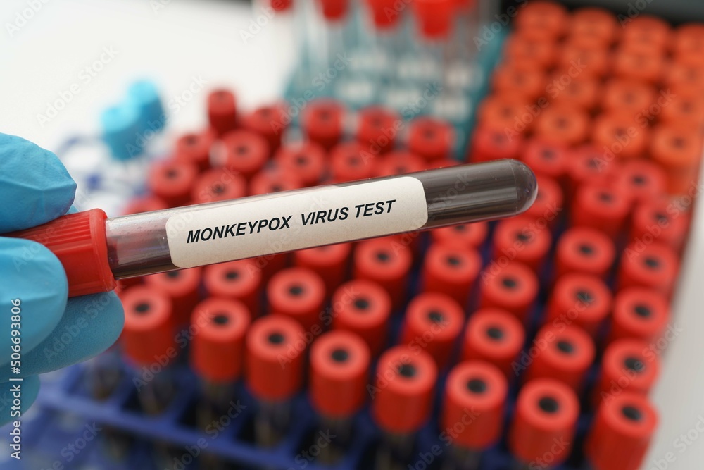 Blood sample tube for Monkeypox virus test. Known as Moneypox virus ...