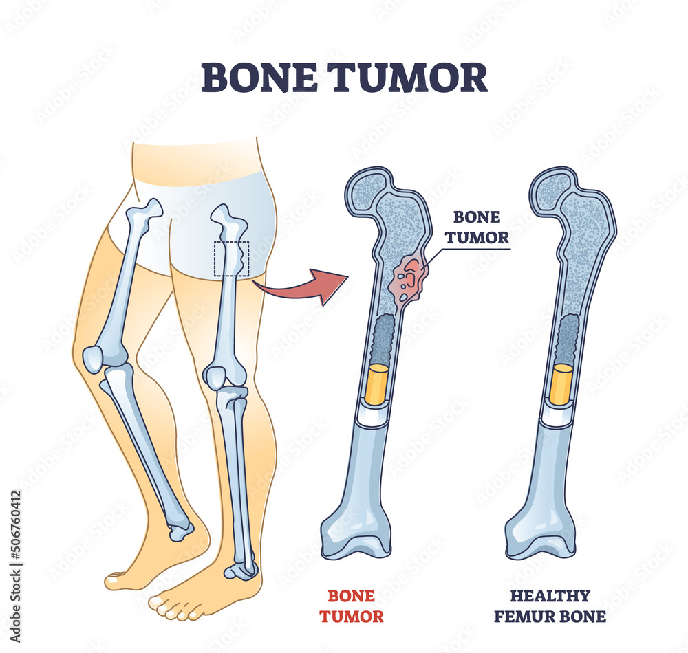 Bone tumor as abdominal tissue growth on human skeleton outline diagram ...