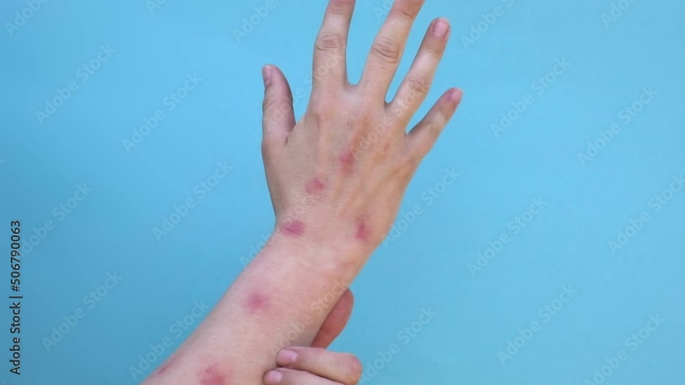 Monkeypox new disease dangerous over the world. Patient with Monkey Pox ...