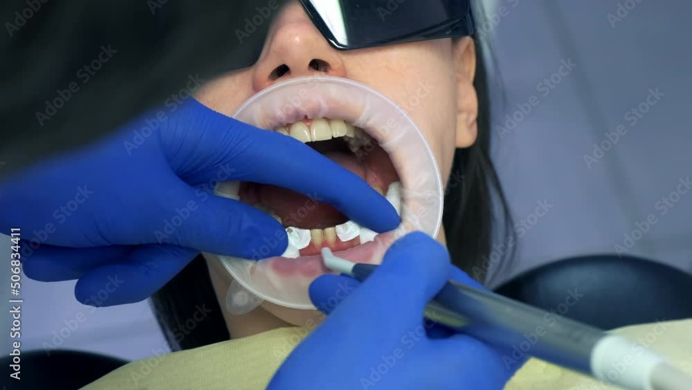Dentist is preparing woman's teeth for installing ceramic veneers and ...