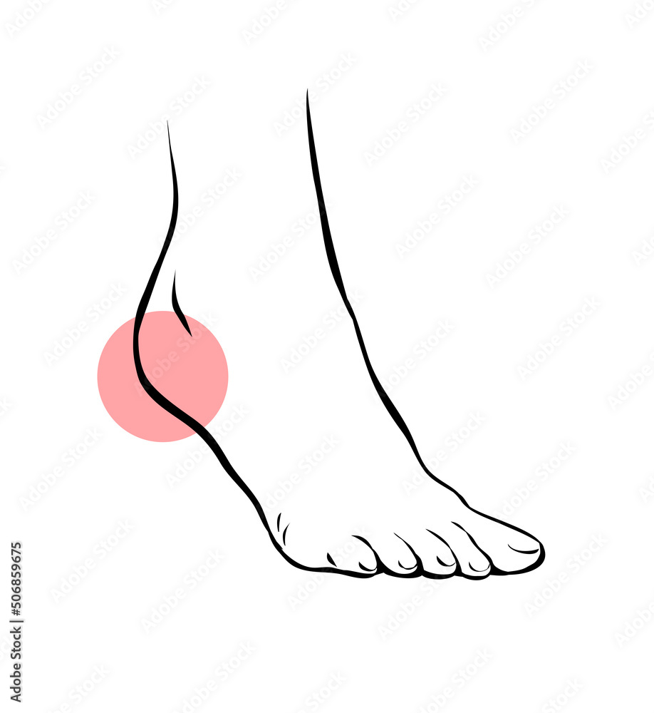Line sketch female leg with problematic pain. Sore heel. Orthopedic ...